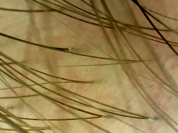 Hair Under the Microscope and Trichoscope - Otter Valley Trichology Clinic
